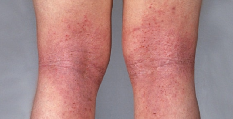 Side Effects of Wearing Compression Stockings - (Read More!)