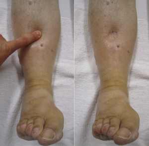 Compression Socks For Edema - (The Ultimate Guide!)