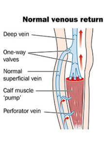 Varicose Veins Compression Stockings – Complete Guide (with Pictures)